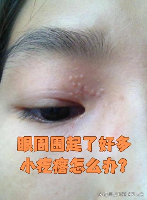眼周突然起了好多红包