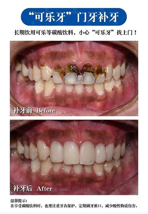 严重的可乐牙怎么修复图标