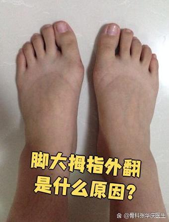 大拇指外翻图标