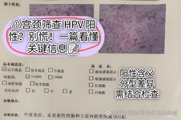 女性hpv68阳性算不算严重