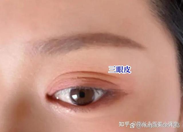 眼睛双眼皮变成了三眼皮怎么回事截图