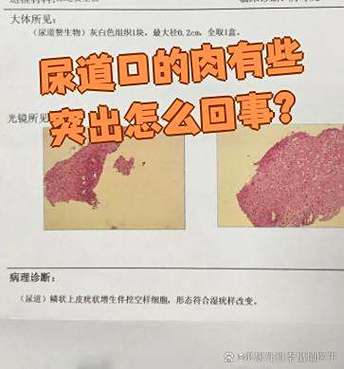 尿道有个肉球突出是怎么回事截图
