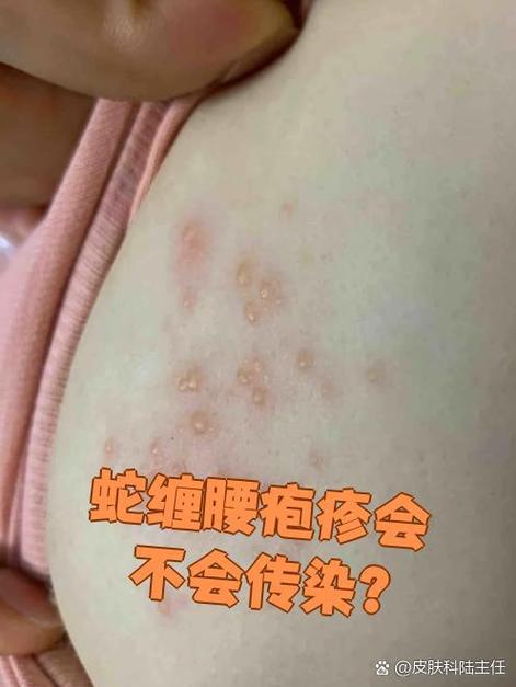 蛇被病毒会不会传染图标