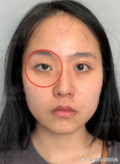 大小眼怎么改善
