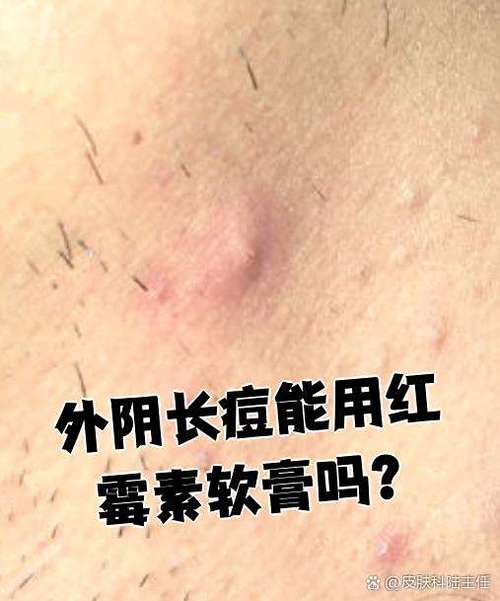 女生私下长痘痘怎么回事