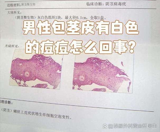 阴痉上有白色的痘痘不疼不痒图标