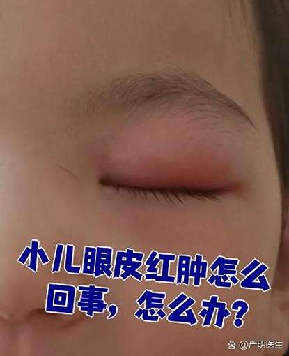 小孩眼睛红是什么原因截图