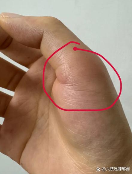 手指弹跳是怎么回事截图