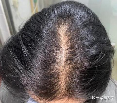 男生发旋处头发少