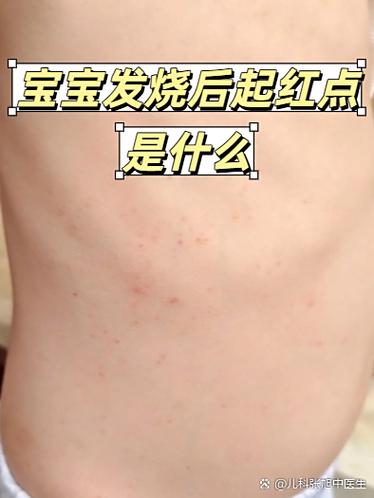 病毒疹是怎么回事图标