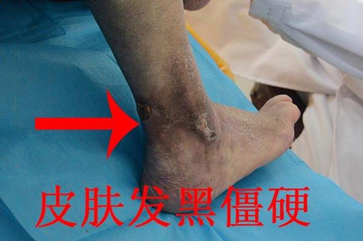 糖尿病进入恶化期是什么症状图标