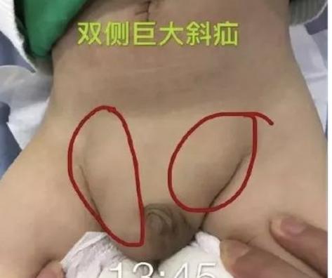 睾丸疝气图片缩略图