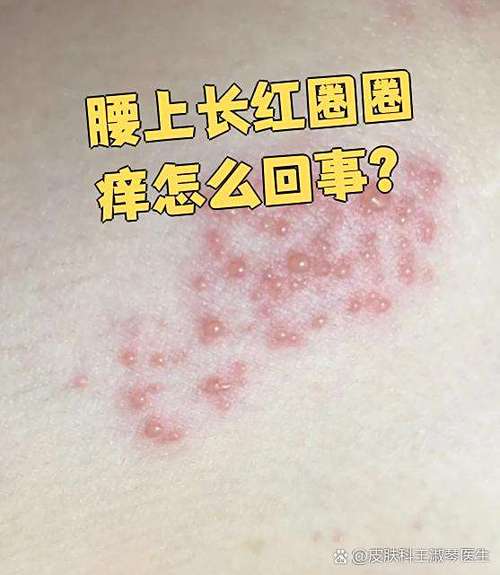 腰两侧特别痒越抓越痒截图