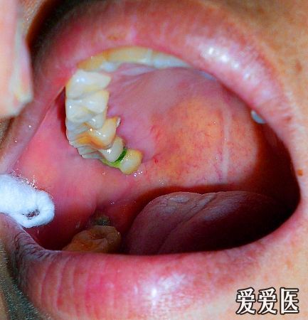 腿部皮肤出现红色斑块图片图标
