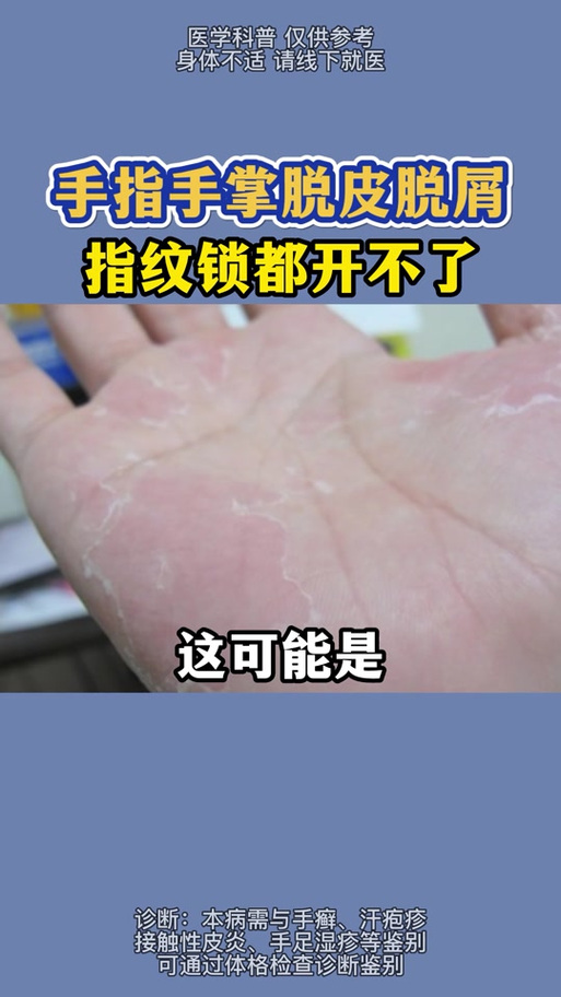 手指脱皮没有指纹怎么快速恢复图标