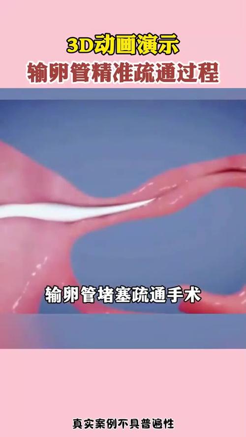 输卵管堵塞中药调理能通吗图标