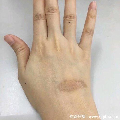 可痕怎么洗掉