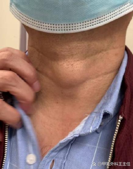 男性甲状腺结节图标