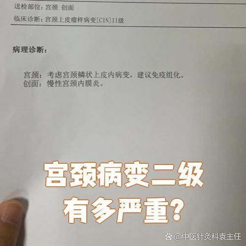 宫颈cin2级到底多严重图标