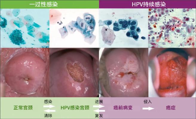 hpv病毒是什么原因引起的截图