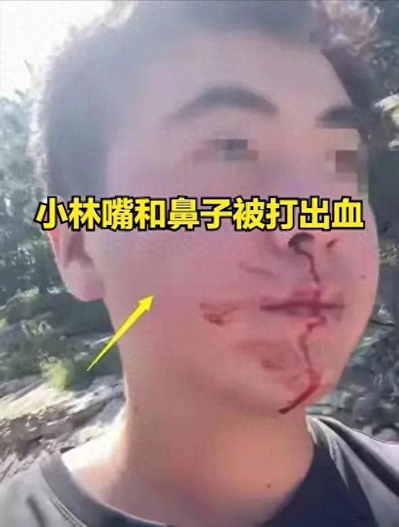 打架流鼻血严重吗