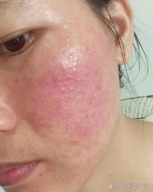 脸上突然起了一块红斑图标