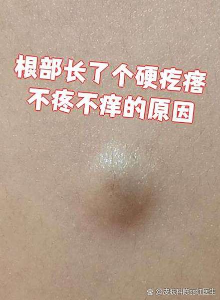 牛牛根部出现红疙瘩图标