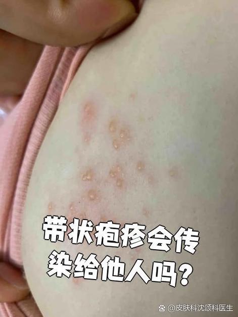 疱疹病毒会传染别人吗图标