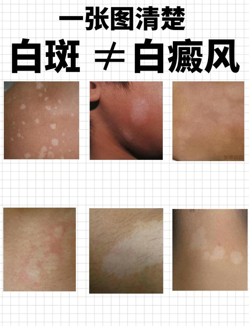 皮肤长白斑点,是什么原因引起?图标