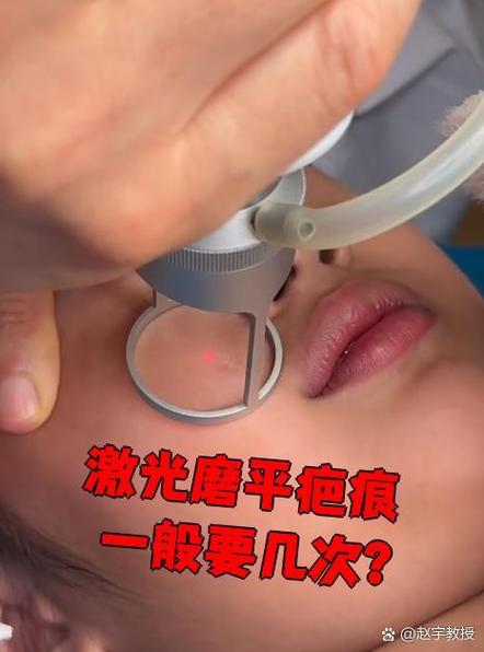 增生疤痕做激光几次能治好