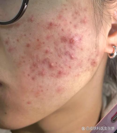 面部病毒感染
