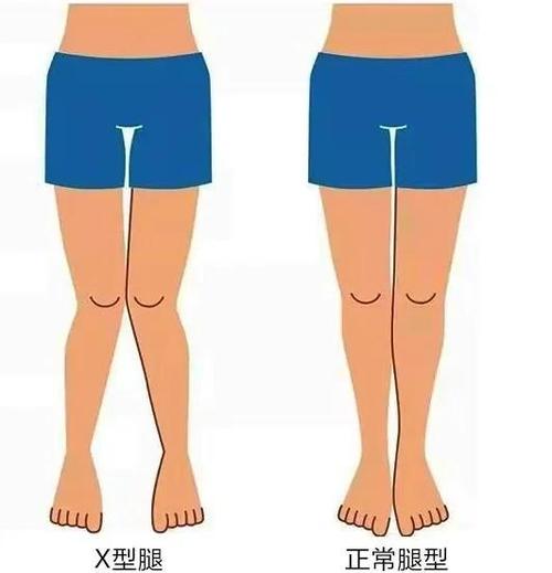 如何矫正x型腿方法图标