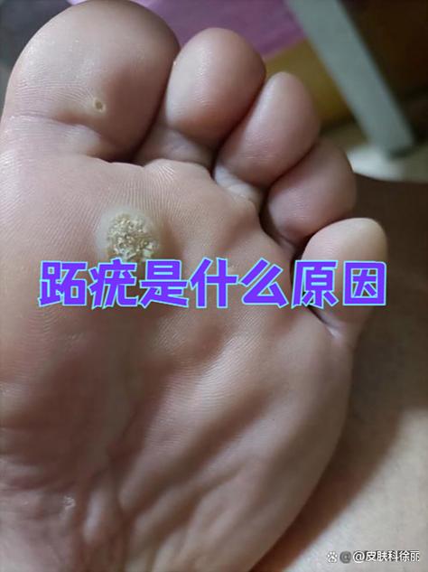 脚上长跖疣怎么办图标