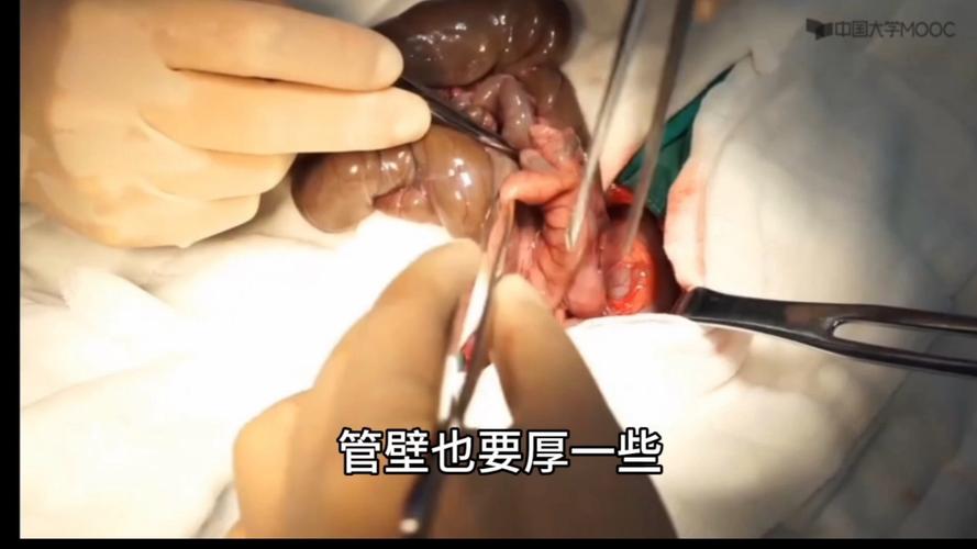 阑尾炎手术模拟视频图标