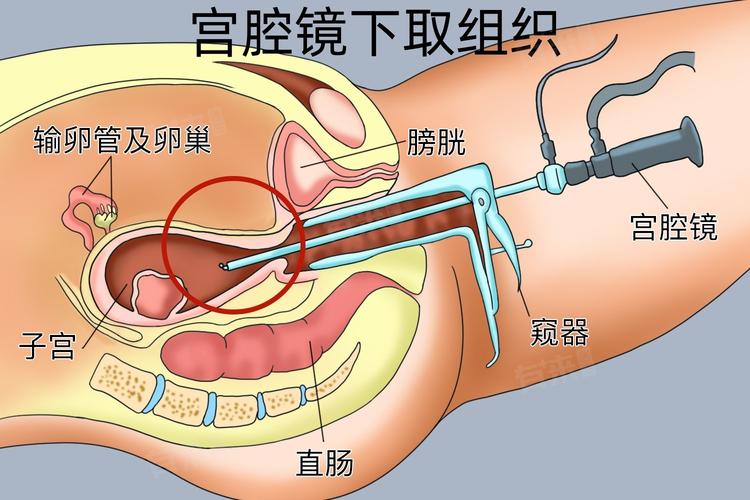 做宫腔镜要做什么检查图标