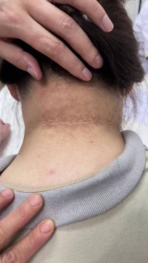 女性私密部位黑是不是黑棘皮截图