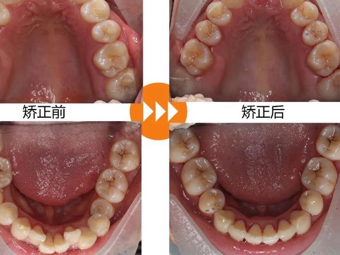 成人牙歪了怎么矫正视频截图