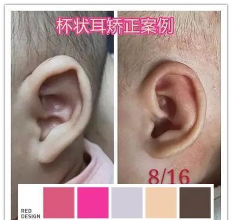 宝宝耳朵畸形是什么原因造成的图标