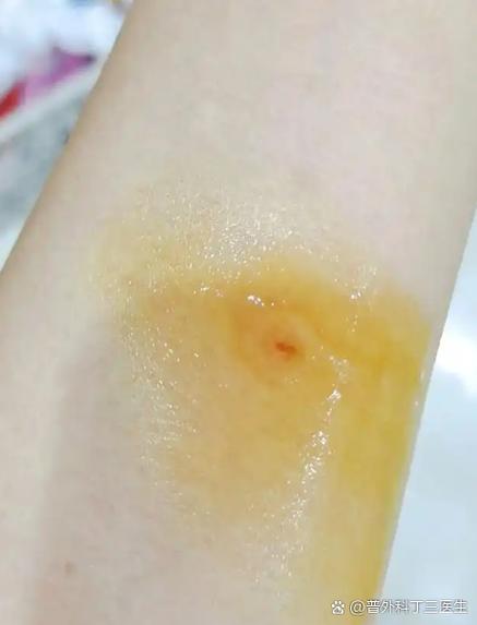下面流白水是什么原因造成的?图标