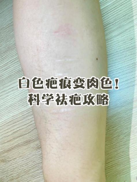疤痕变白了怎样才可以恢复肉色
