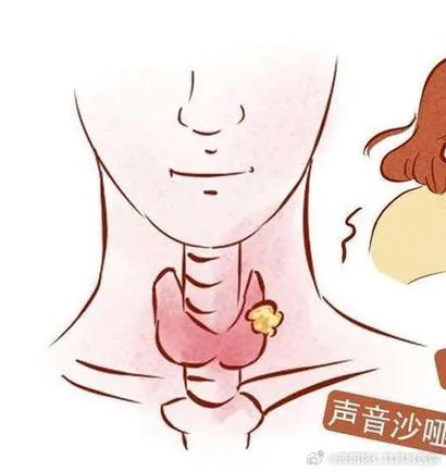 长期声音嘶哑是什么原因造成的截图