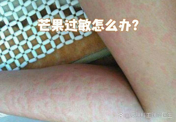吃芒果过敏症状截图