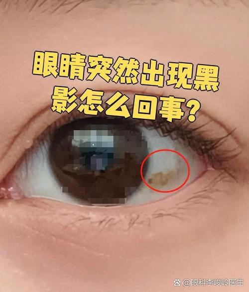 眼睛有团黑影怎么回事