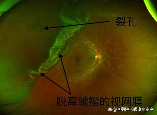 视网膜病变可以治愈吗图标
