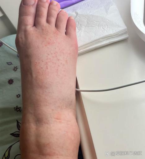 脚特别痒越抓越痒怎么办图标