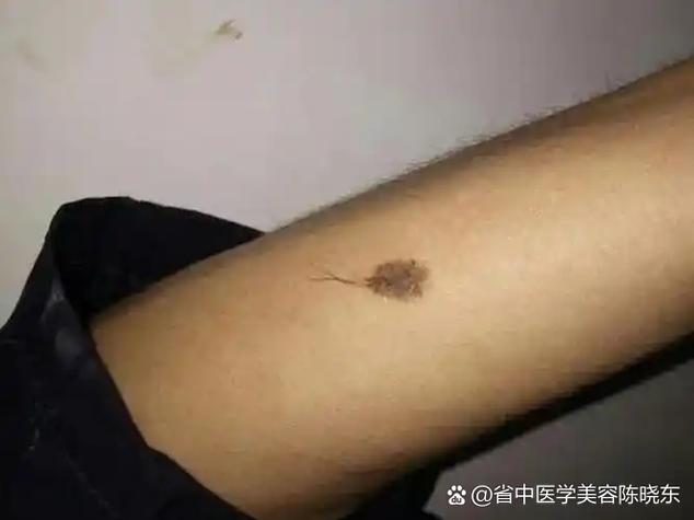 如何拔毛才不会再长毛图标