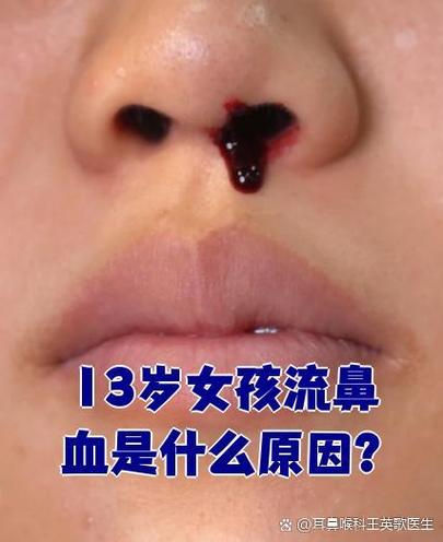 鼻子骨头长歪了流鼻血截图