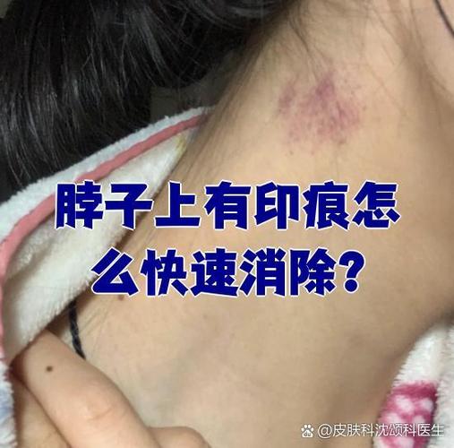 脖子上印痕怎么去掉图标