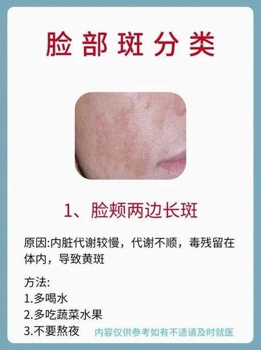 额头长斑是什么原因引起的图标