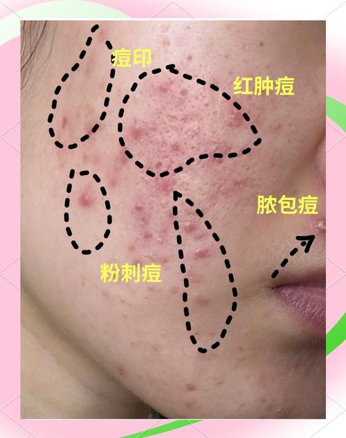脸上痘印怎么办才能彻底去除图标